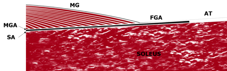 Medial Gastrocnemious Tears In Sports: Is It About Muscle, Aponeurosis ...