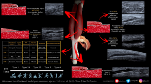 Medial Gastrocnemious Tears In Sports: Is It About Muscle, Aponeurosis ...