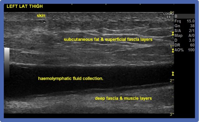 Morel-Lavallee Lesions - Diagnosis and practical management of these ...