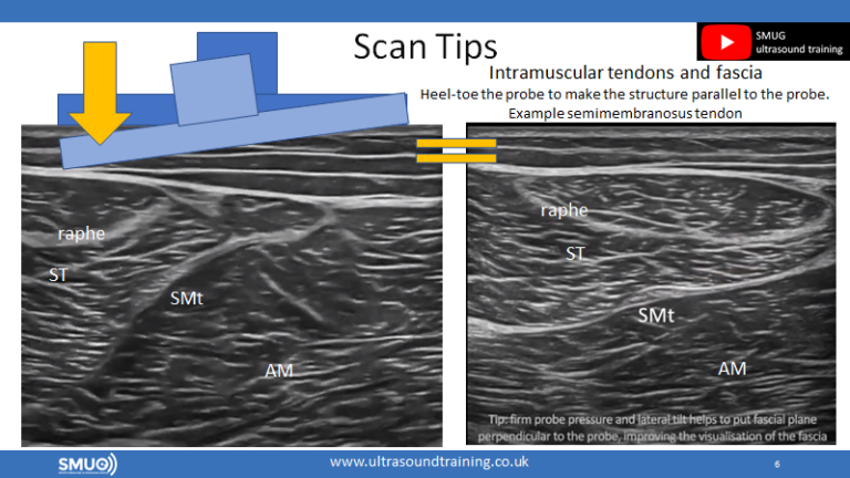Want to up-skill in using ultrasound for muscle injuries? - BJSM blog ...