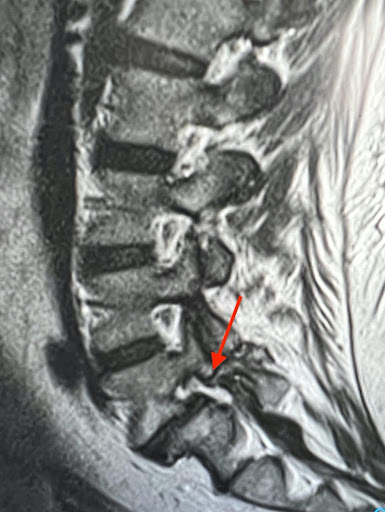 Don’t Stress about your fractures! Have you tried VIBE-MRI? - BJSM blog ...
