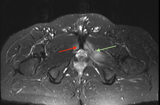 Don’t Stress about your fractures! Have you tried VIBE-MRI? - BJSM blog ...