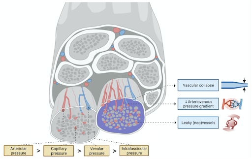 The overlooked role of intratendinous pressure in tendinopathy: A new ...