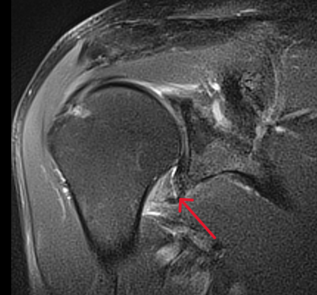 The MSK Playbook: Frozen Shoulder - BJSM blog - social media's leading ...