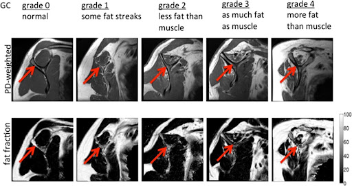 The MSK playbook: Rotator cuff tears and tendinopathy. - BJSM blog ...
