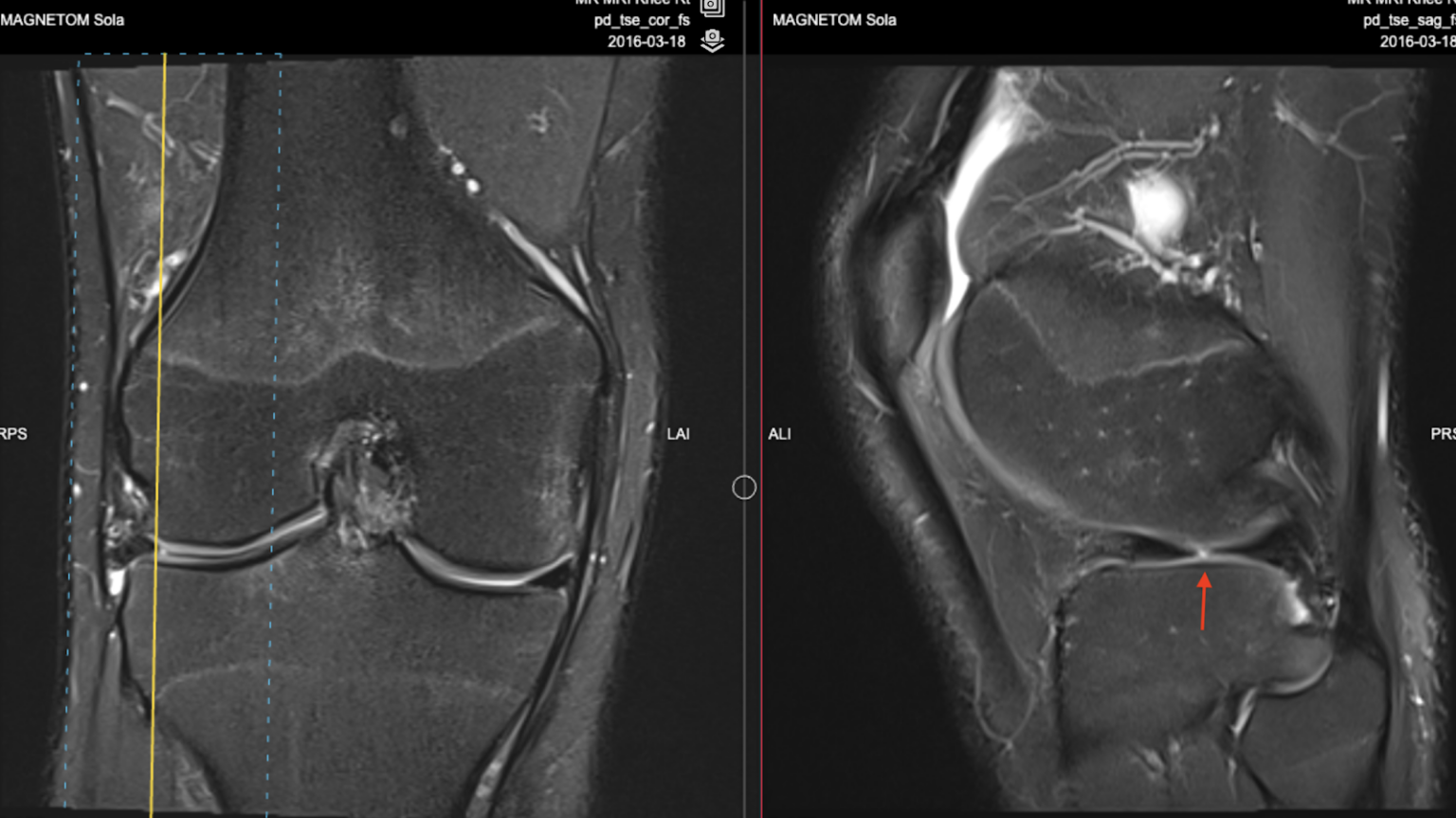 The MSK playbook – Meniscal Knee Injuries - BJSM blog - social media's ...
