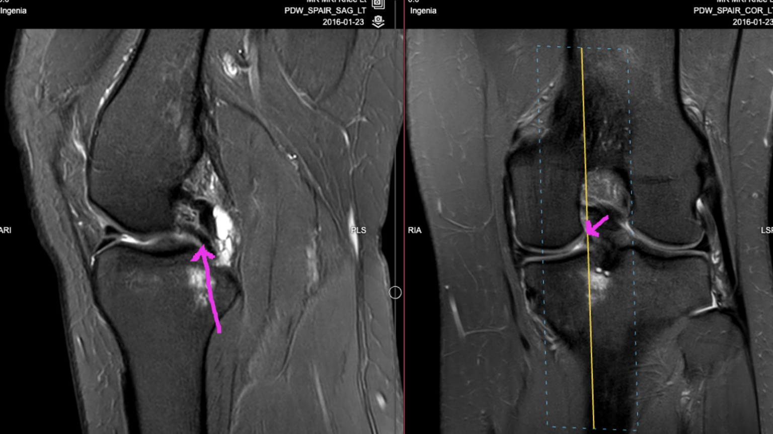 The MSK playbook – Meniscal Knee Injuries - BJSM blog - social media's ...
