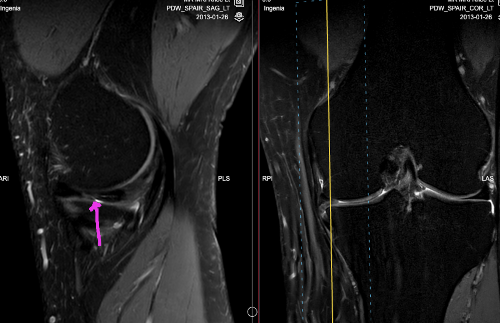 The MSK playbook – Meniscal Knee Injuries - BJSM blog - social media's ...
