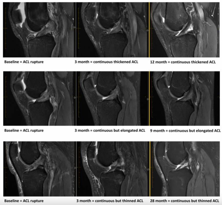 Can the novel Cross Bracing Protocol facilitate healing of ACL rupture ...