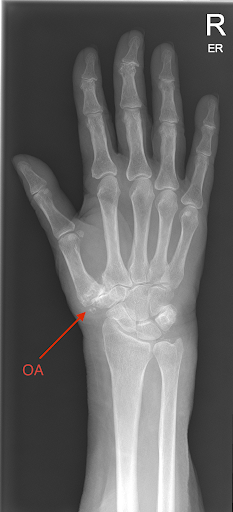 The MSK playbook - hand arthritis - BJSM blog - social media's leading ...