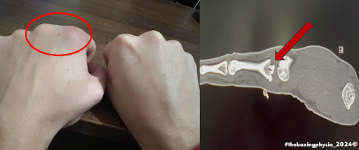 The MSK playbook - hand arthritis - BJSM blog - social media's leading ...