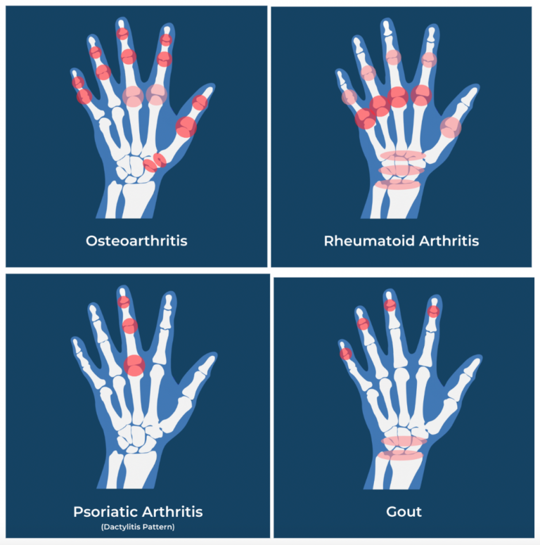 The MSK playbook - hand arthritis - BJSM blog - social media's leading ...