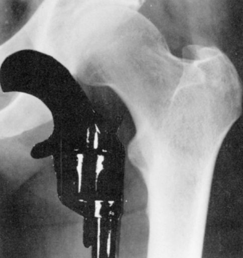 The MSK Playbook - Femoral Acetabular Impingement Syndrome - BJSM blog ...