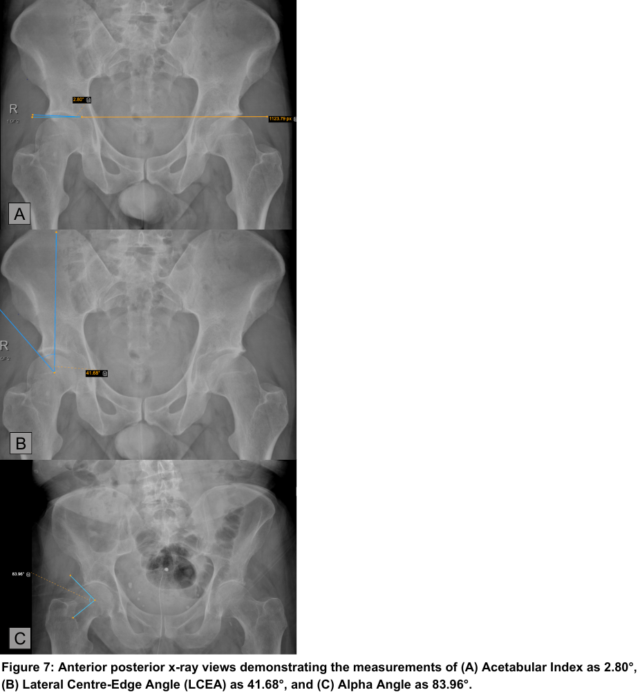 The MSK Playbook - Femoral Acetabular Impingement Syndrome - BJSM blog ...