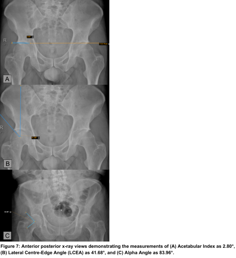 The MSK Playbook - Femoral Acetabular Impingement Syndrome - BJSM blog ...