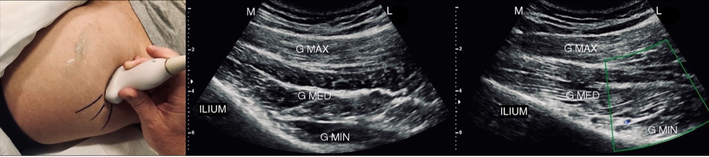 The MSK playbook: Greater Trochanteric Pain Syndrome - BJSM blog - social media's leading SEM voice