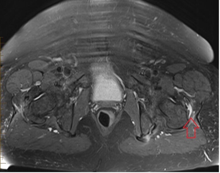The MSK playbook: Greater Trochanteric Pain Syndrome - BJSM blog ...