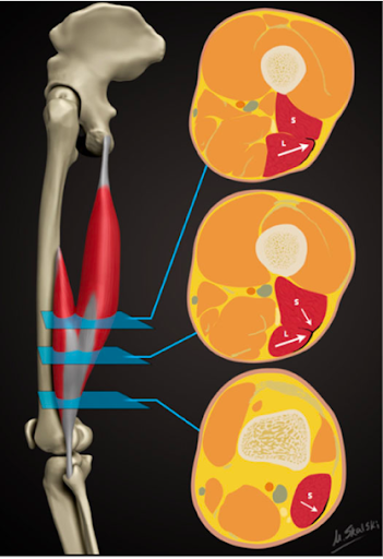 The ‘nervy’ business of T-junction hamstring injuries - BJSM blog ...