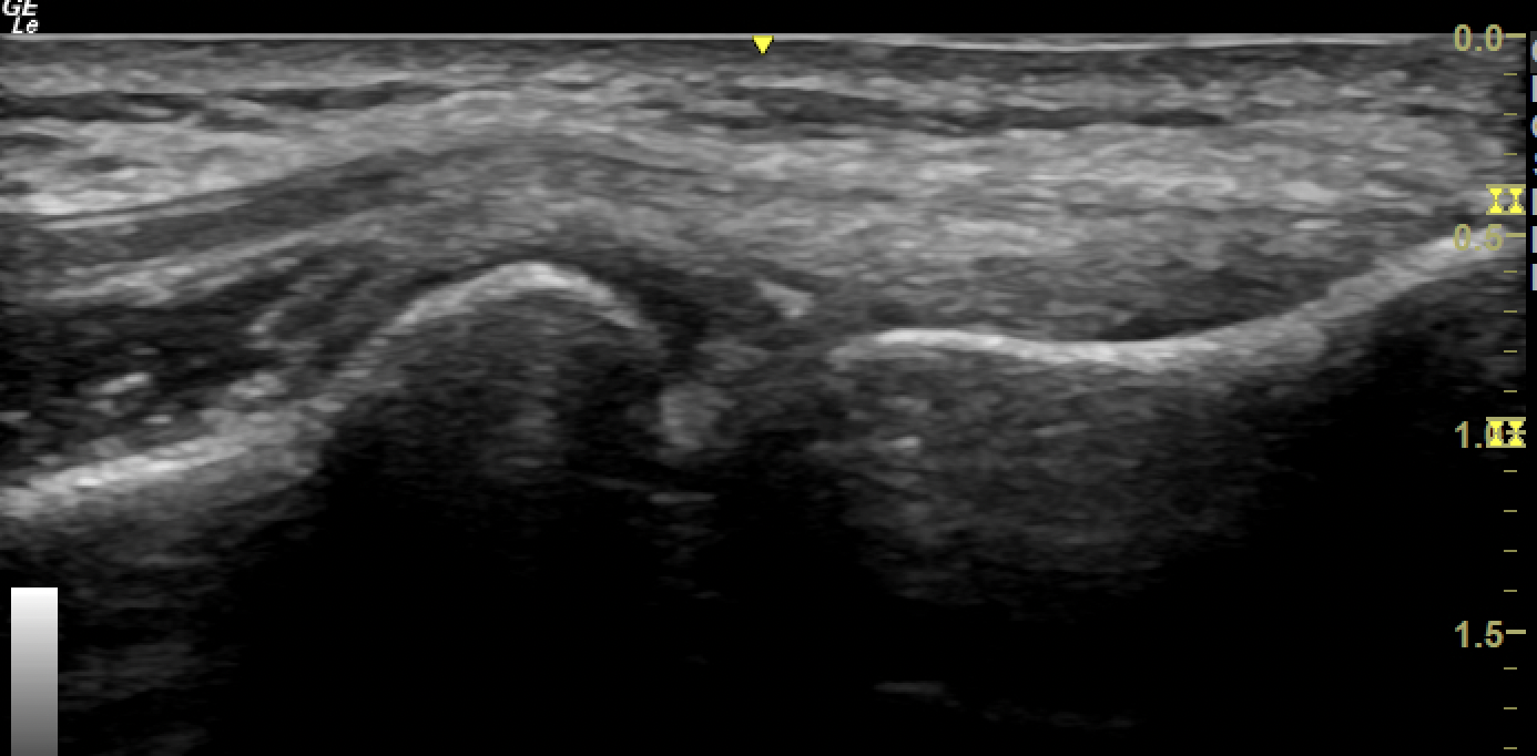 The MSK playbook: Tennis elbow - BJSM blog - social media's leading SEM ...