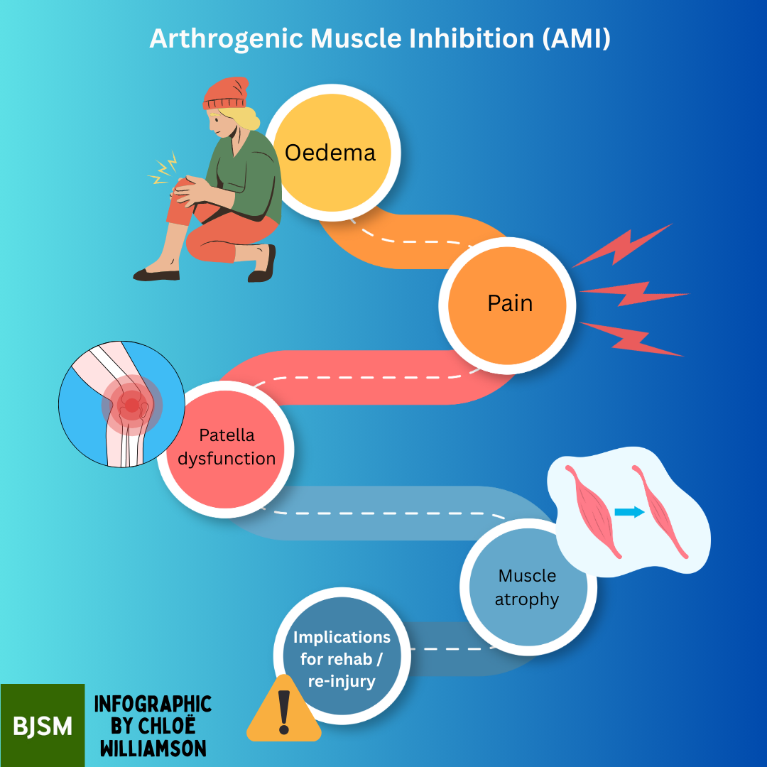 Arthrogenic Muscle Inhibition (AMI) phenomenon of periarticular knee ...
