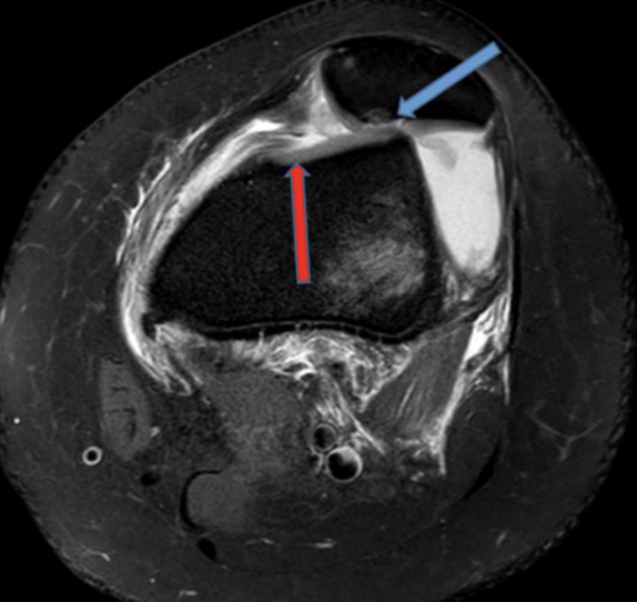 The MSK Playbook: Chondromalacia Part 1 - BJSM blog - social media's ...