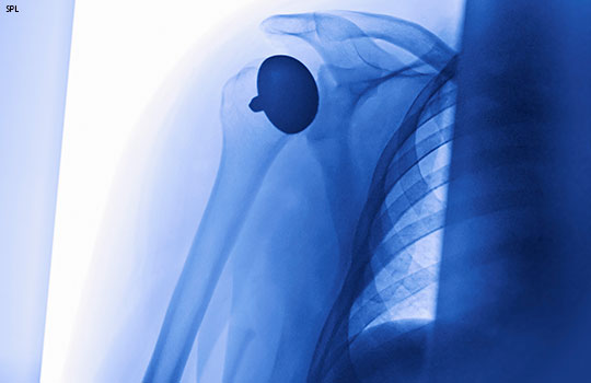 Providing better evidence in orthopaedic surgery: RCTs, registries, or ...
