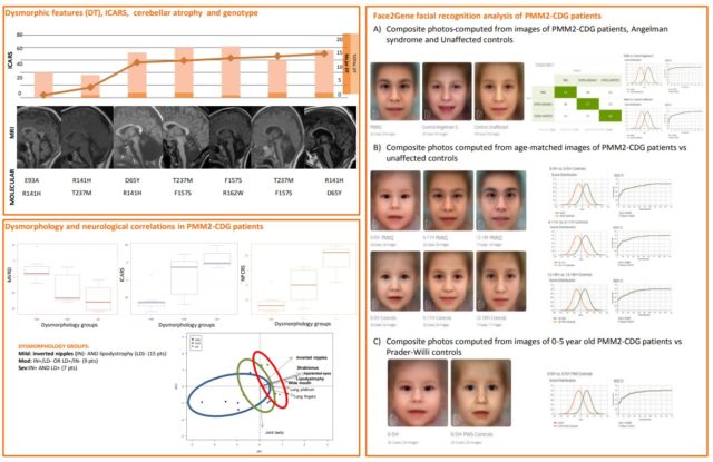 From gestalt to gene: early predictive dysmorphic features of PMM2-CDG ...