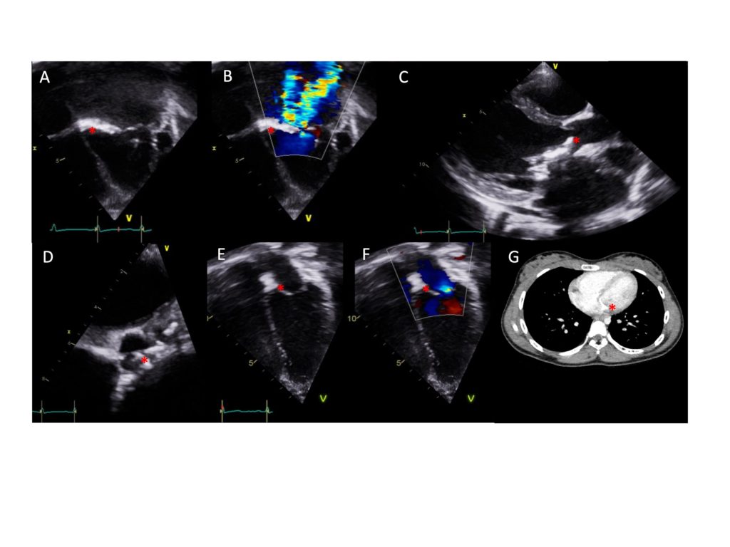 Cardiac valve involvement in ADAR-related type I interferonopathy ...