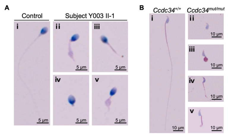 Homozygous mutations in CCDC34 cause male infertility with oligoasthenoteratozoospermia in ...