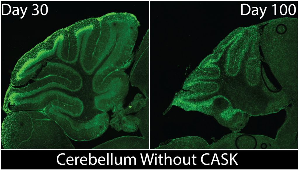 Complete loss of the X-linked gene CASK causes severe cerebellar ...