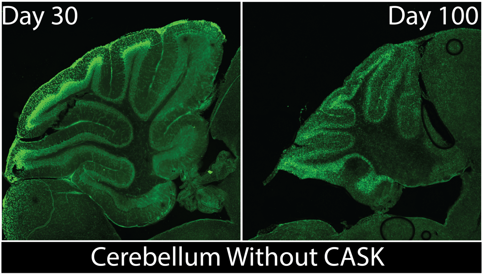 Complete loss of the X-linked gene CASK causes severe cerebellar ...