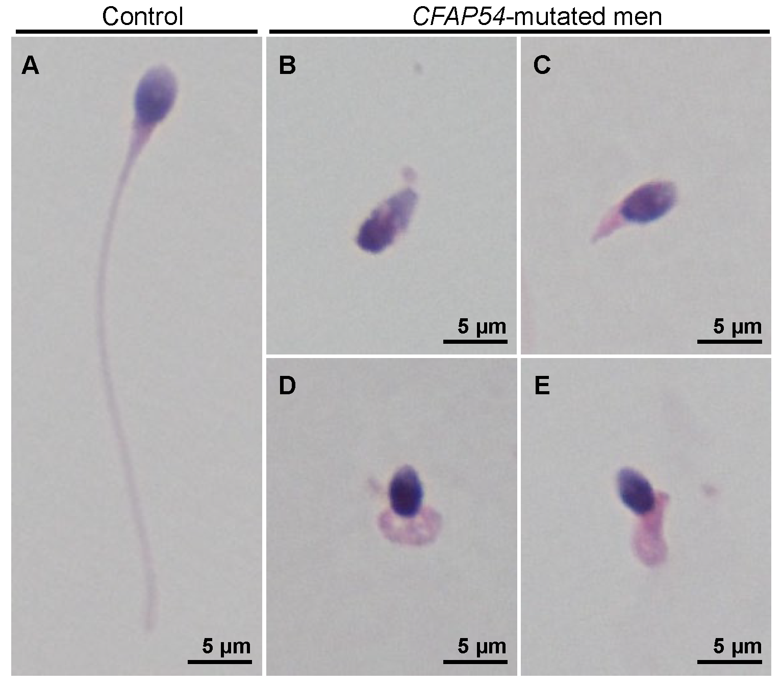 Biallelic mutations in CFAP54 cause male infertility with severe MMAF ...