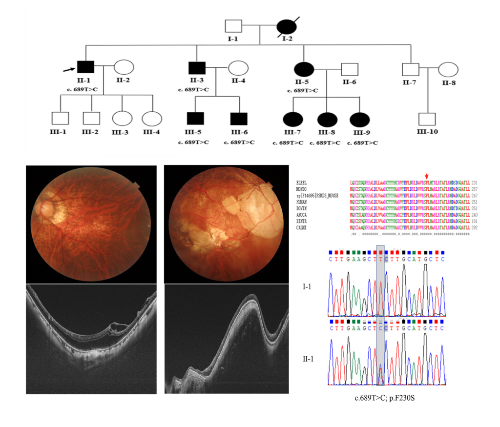 PSMD3 gene mutations cause pathological myopia - JMG Contact blog