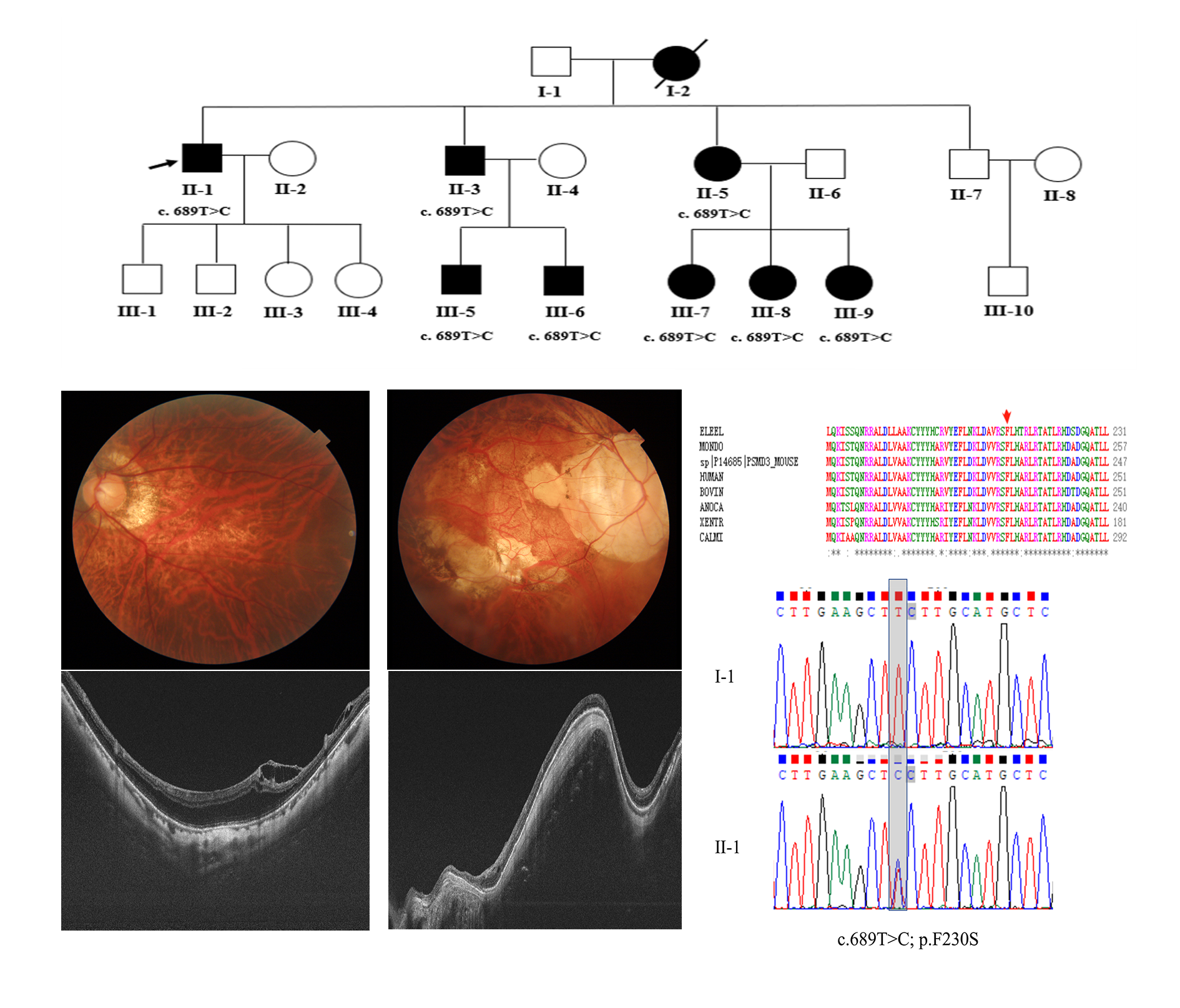 PSMD3 gene mutations cause pathological myopia - JMG Contact blog