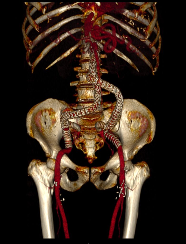 Arterial aneurysm and dissection: toward the evolving phenotype of ...