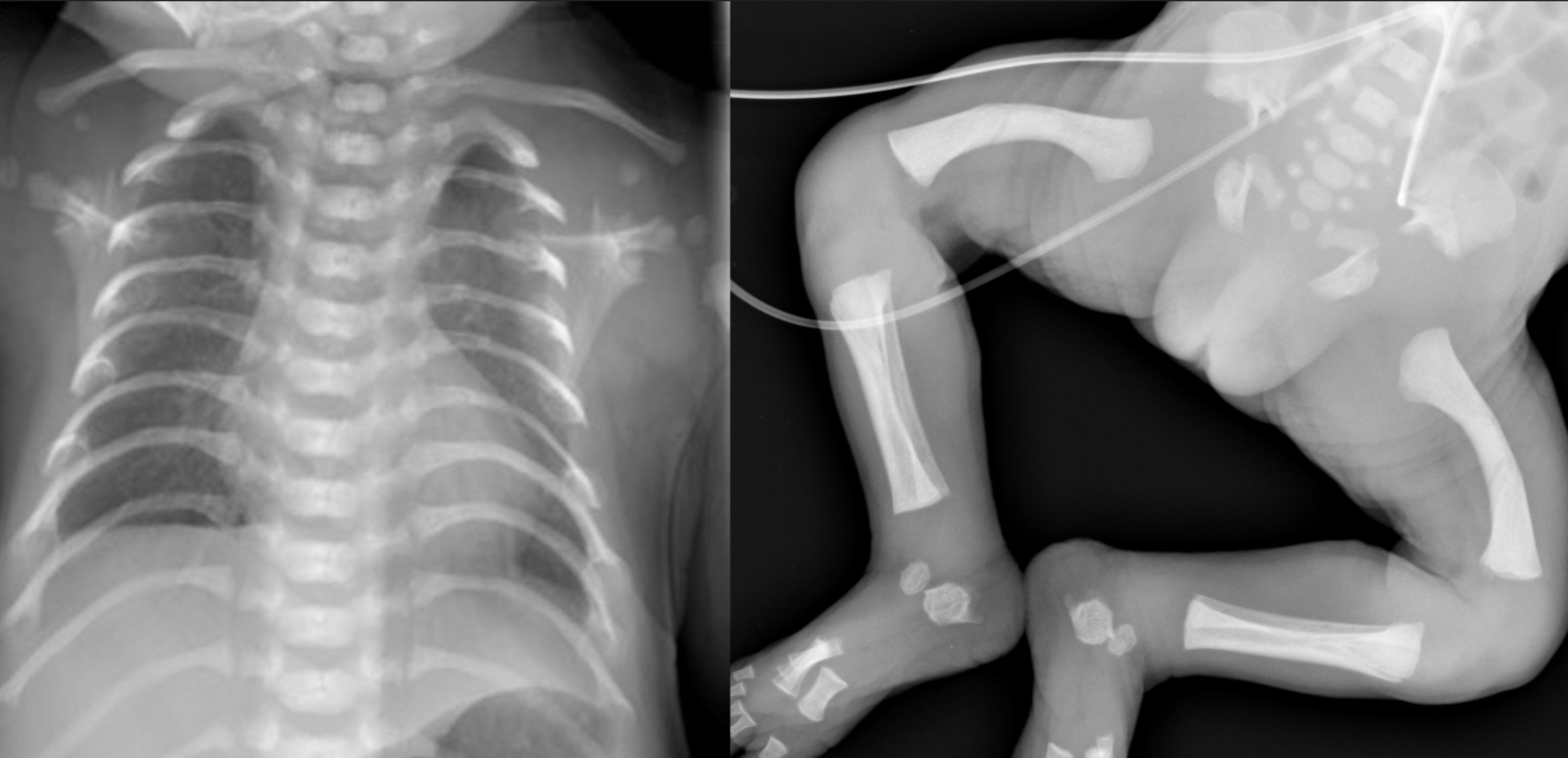 Phenotypic heterogeneity in DYNC2H1-related short-rib thoracic ...