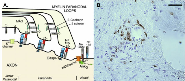 Inflammatory neuropathies with paranodal antibodies: more than just IgG ...