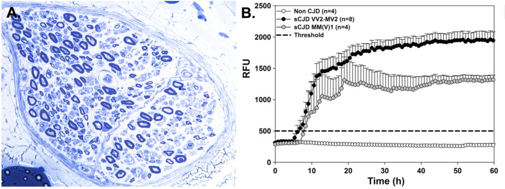 Sporadic Creutzfeldt-Jakob disease: beyond central nervous system ...