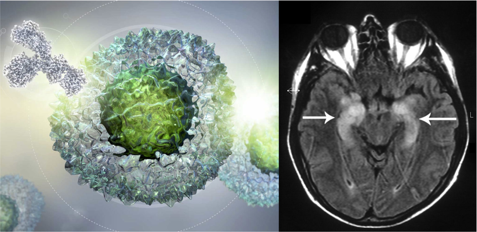 New drugs new adverse effects: Neurology and immune checkpoint ...